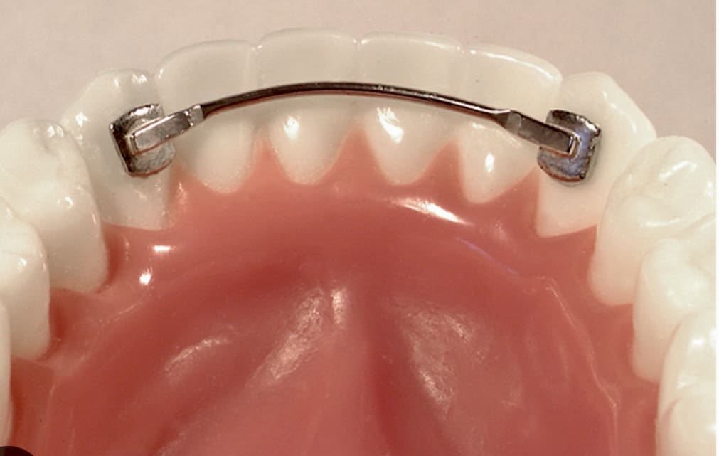 Types Of Metal Retainers